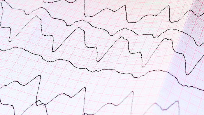 The ERC Guidelines 2021: Peri-arrest arrhythmias (Part 4/7)